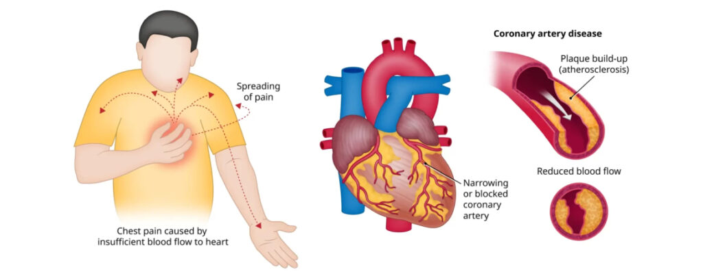 Angina Treatment in Jaipur By Dr. Divij Khetan | Khetan Hospital