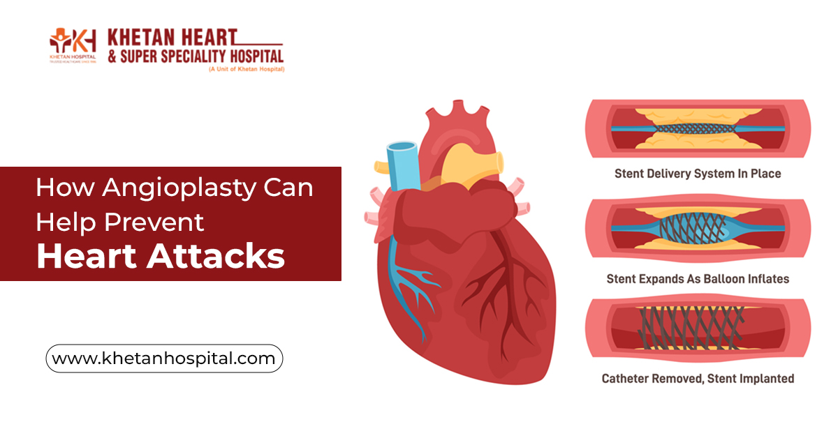 How Angioplasty Helps Prevent Heart Attacks | Khetan Hospital